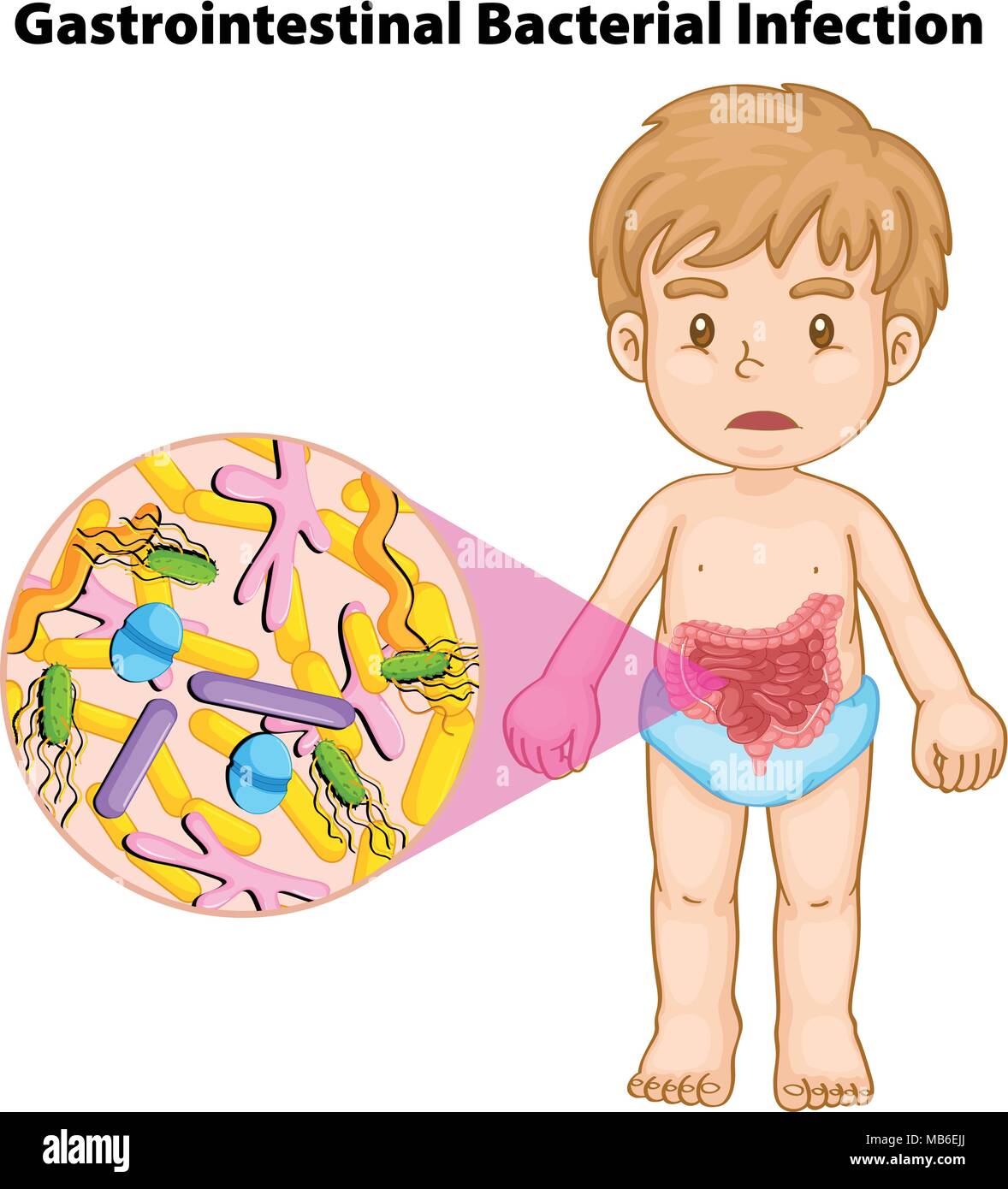 Boy and gastrointestinal bacterial infection illustration Stock Vector ...