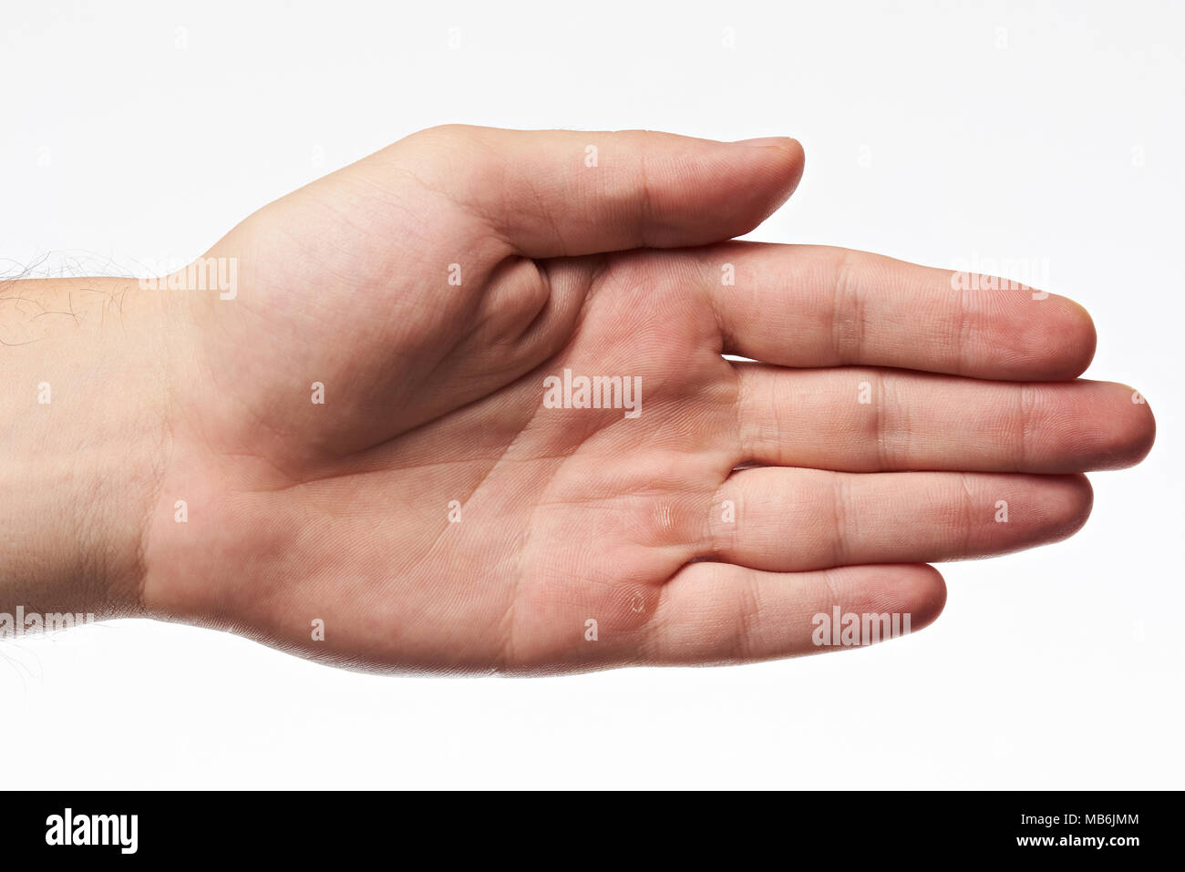 One rough palm hand with blister isolated on white background Stock ...