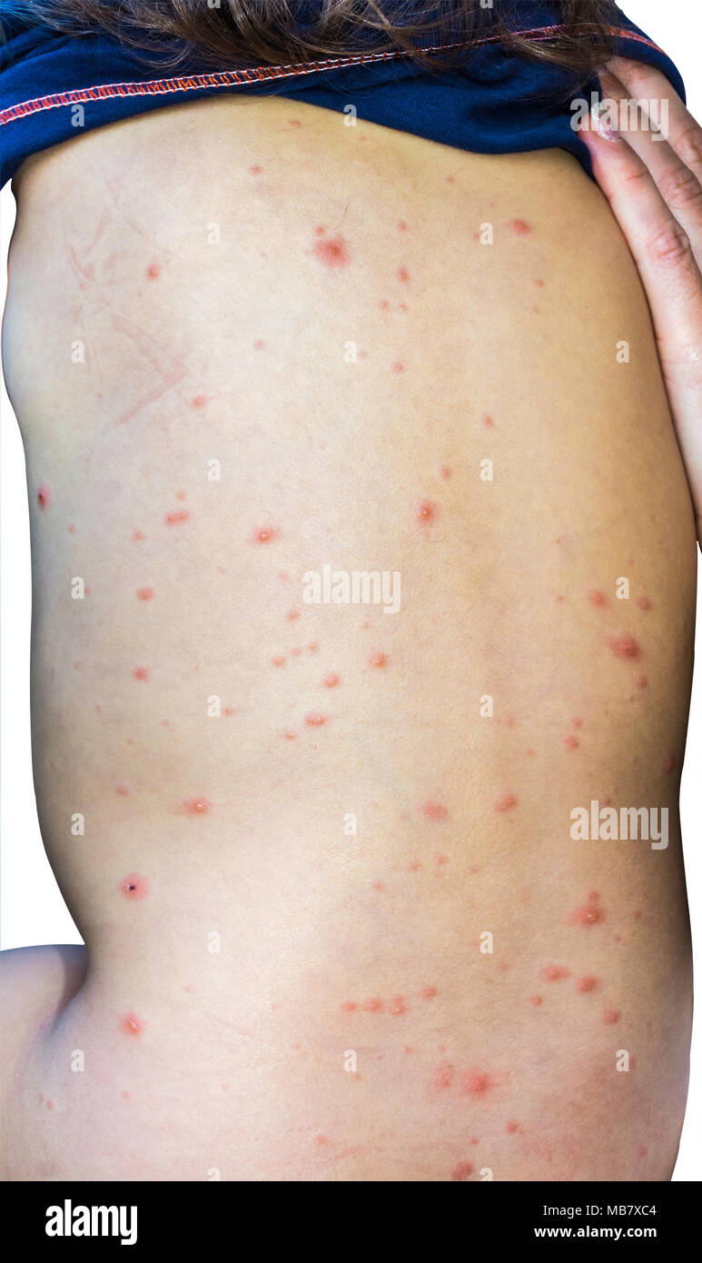 Varicella Rash Images