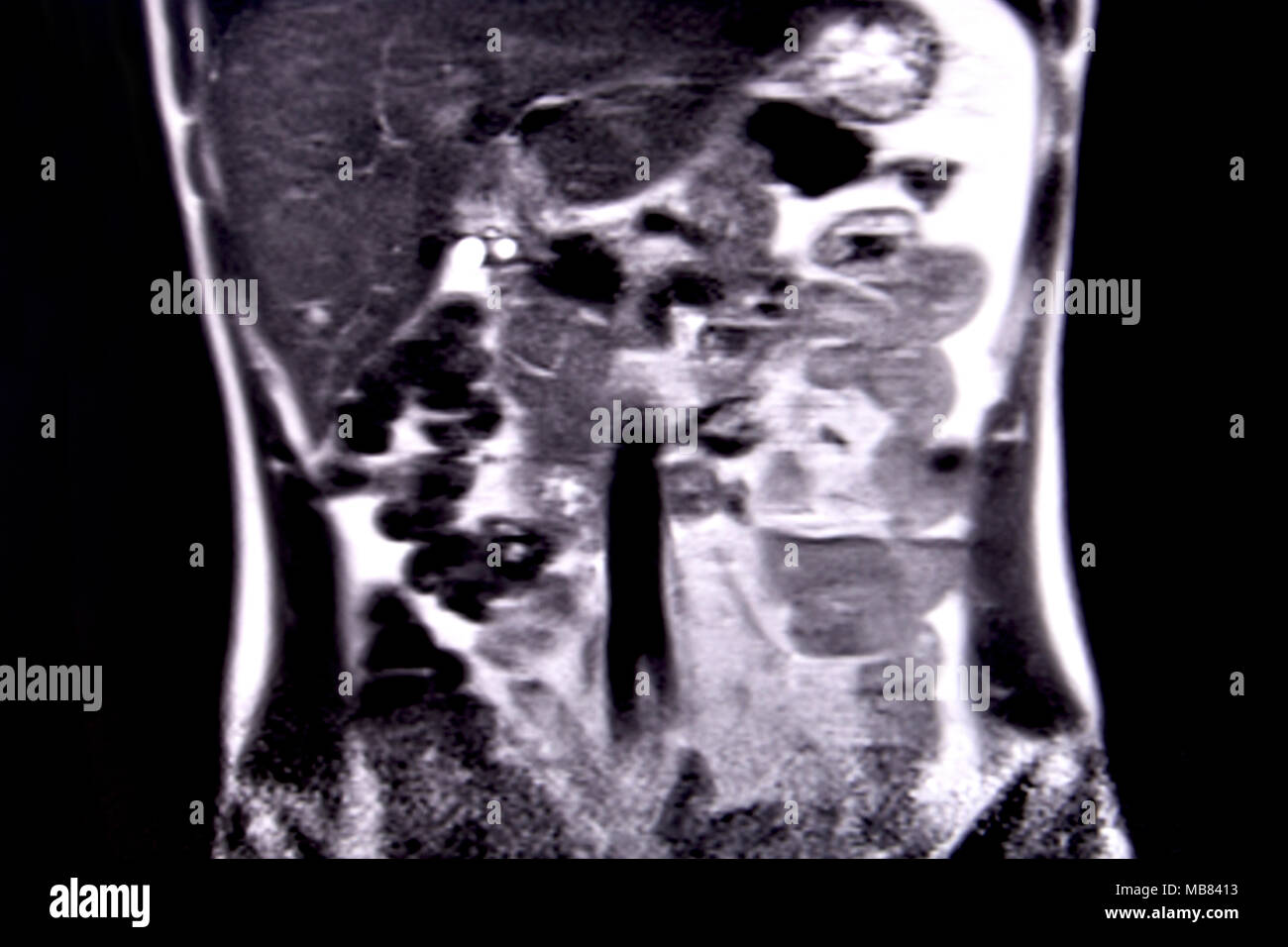 Ride through the human abdomen and chest by means of 18 MRI cuts ...