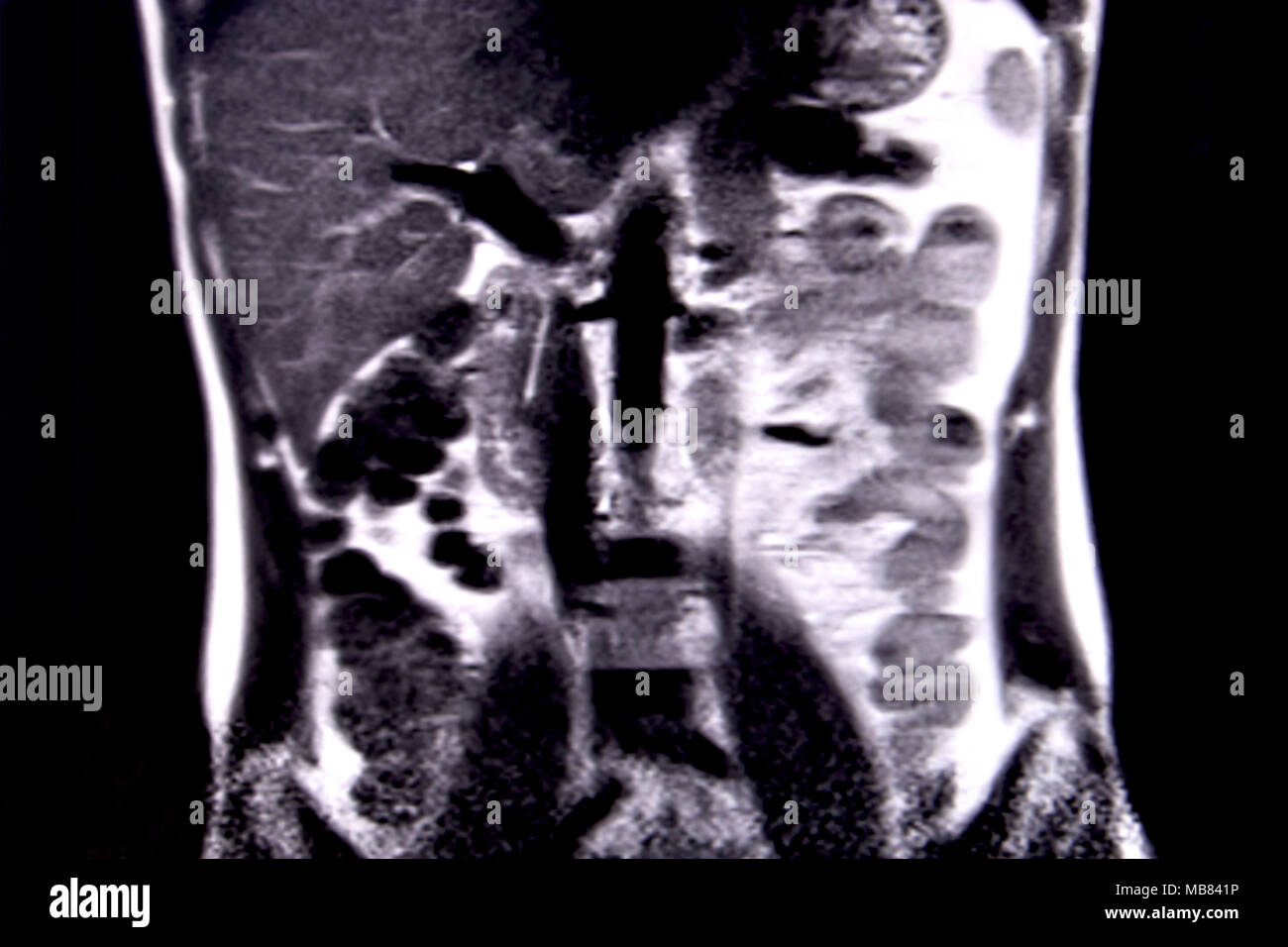 Abdomen mri hi-res stock photography and images - Alamy