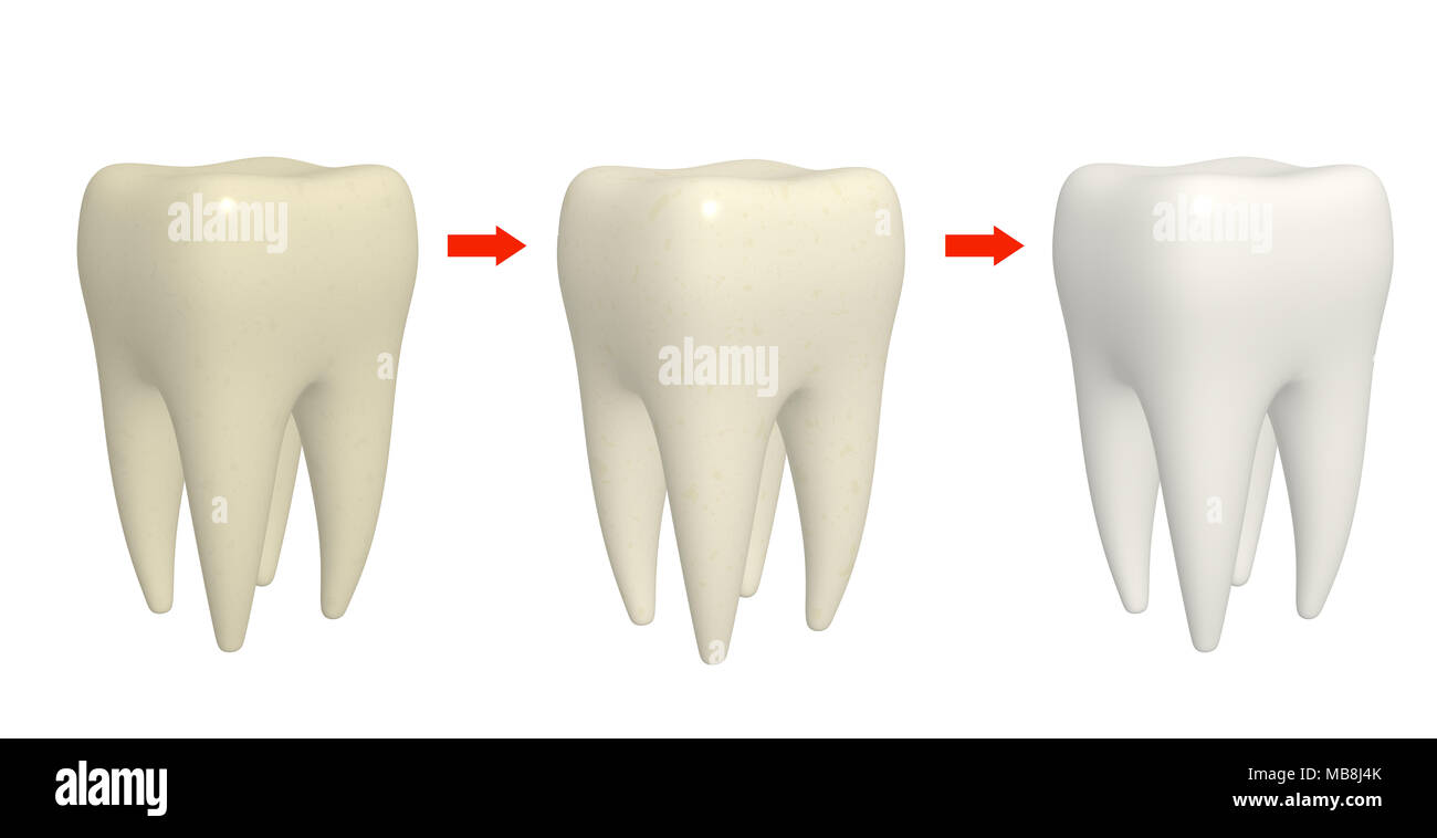 Cleaning tooth process. Human tooth with different enamel color ...