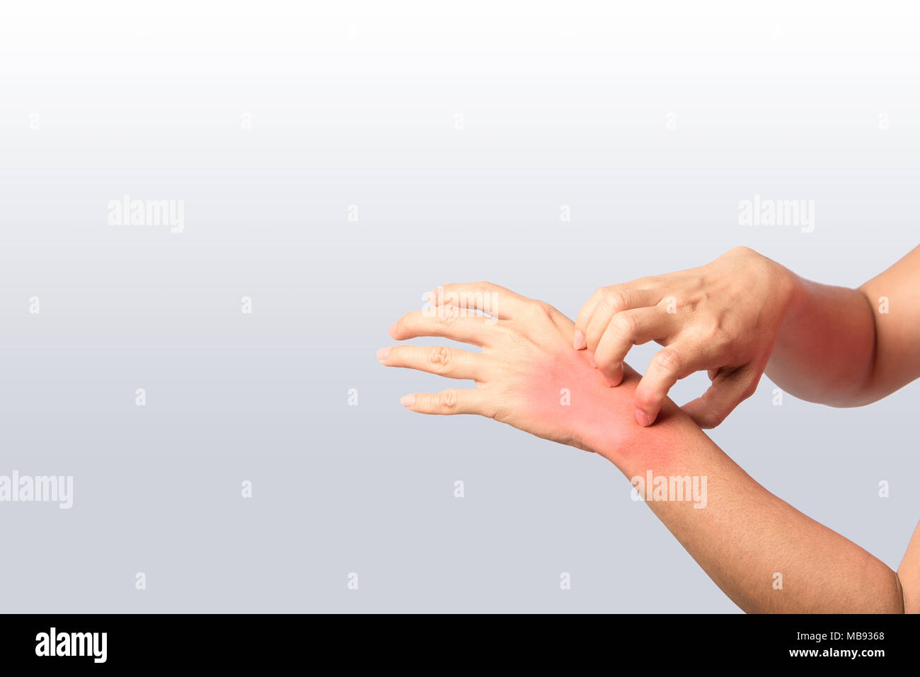 Scratching Arm Stock Photos & Scratching Arm Stock Images - Alamy
