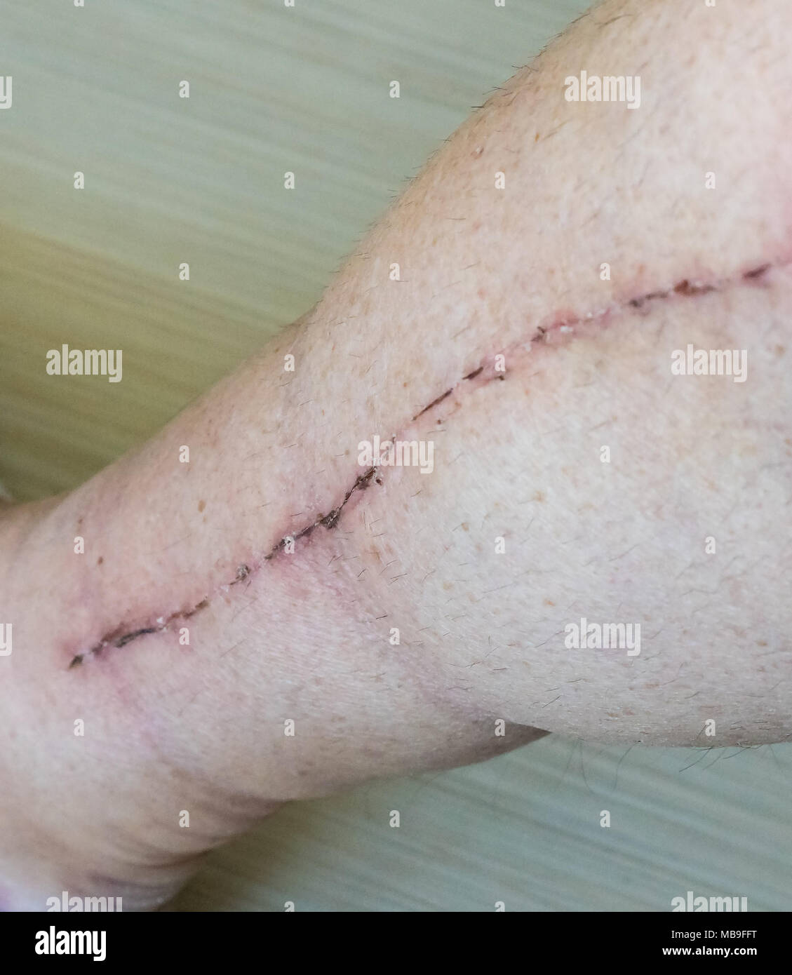 Selective focus of old male human leg with scar from cardiac surgery of ...