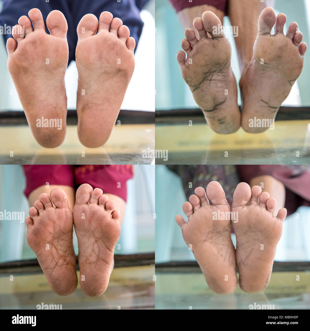 Diabetic foot collection, foot screen in diabetes patient Stock Photo ...