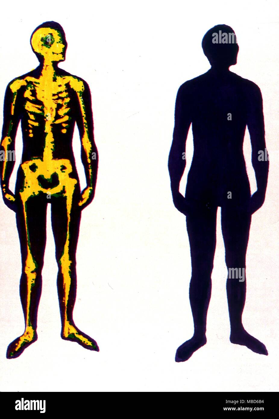 The skeletal system (after a bone scintigram) and the physical body. In ...
