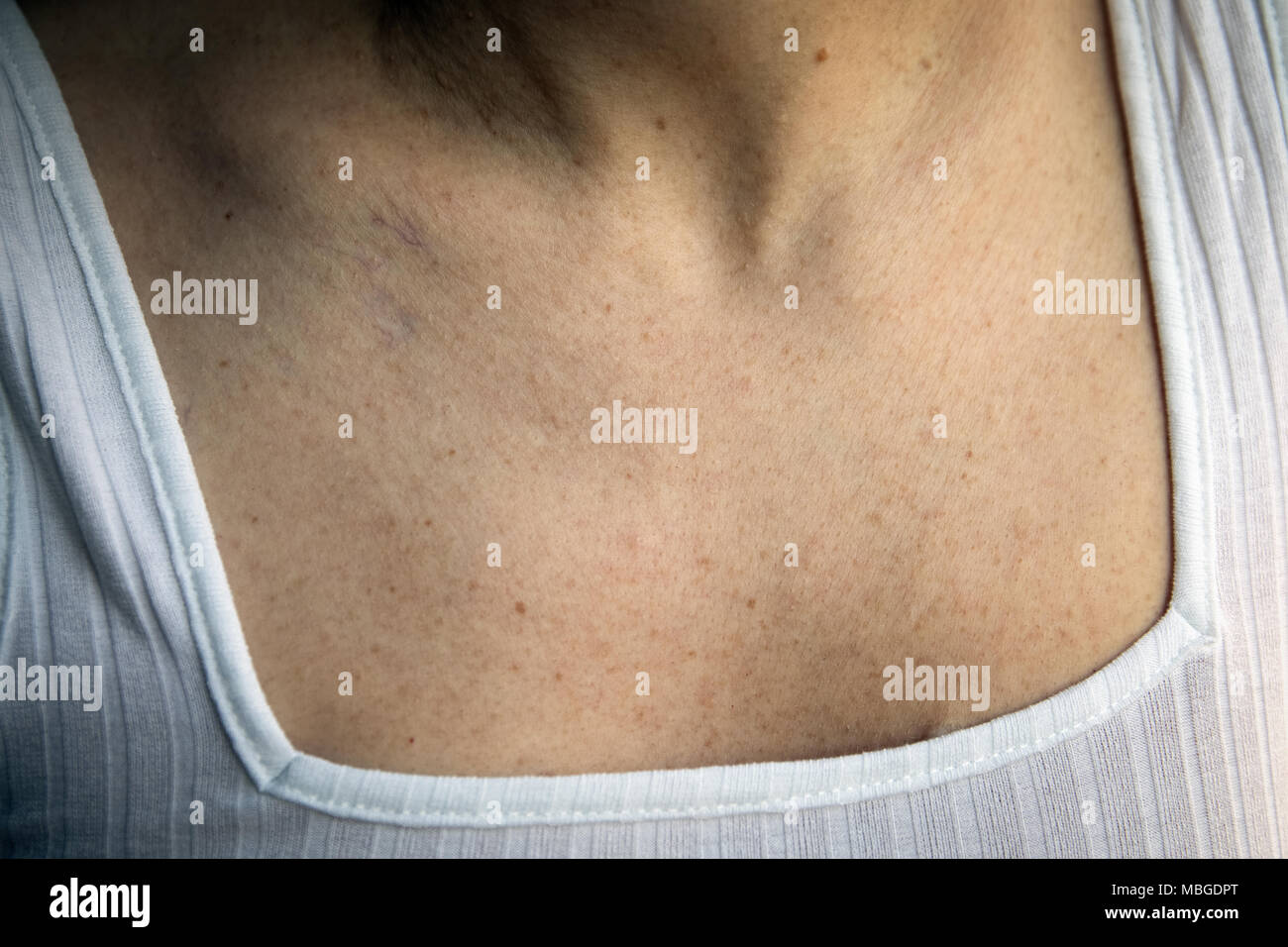 Women with skin pigmentation and lot of birthmarks Stock Photo - Alamy