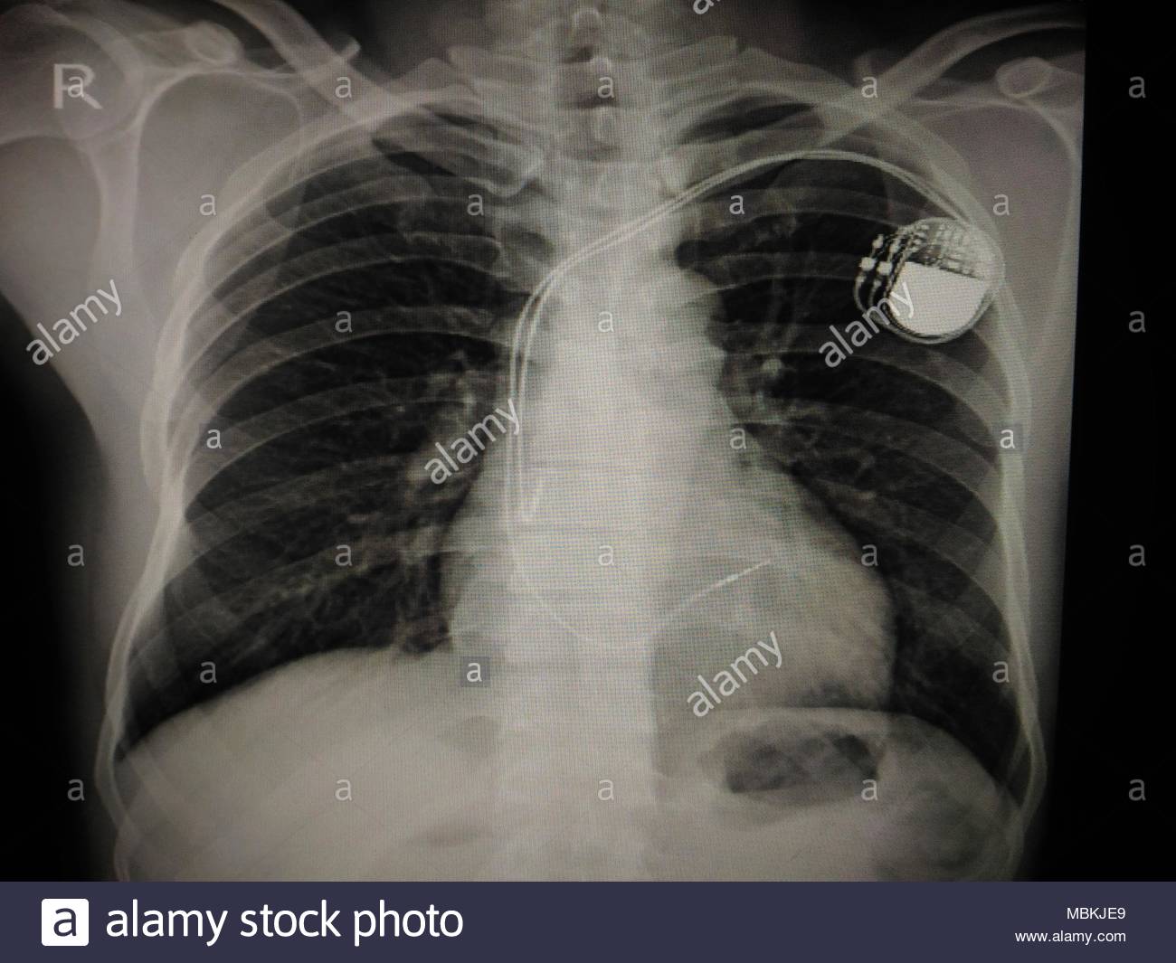 Heart Pacemaker X Ray Stock Photos & Heart Pacemaker X Ray Stock Images ...