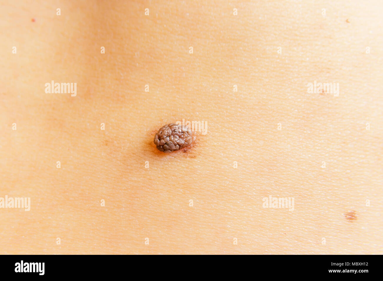 Cancerous mole hi-res stock photography and images - Alamy