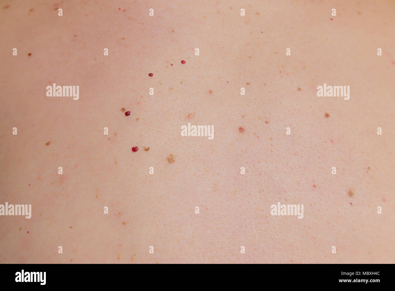Little Red Moles On Skin