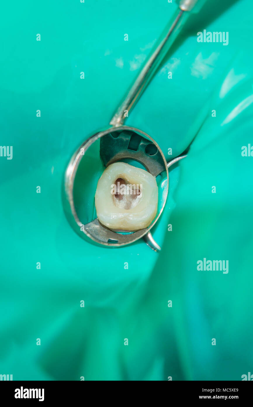 Treatment of the roots of the tooth. Sealing and cleaning a carious ...