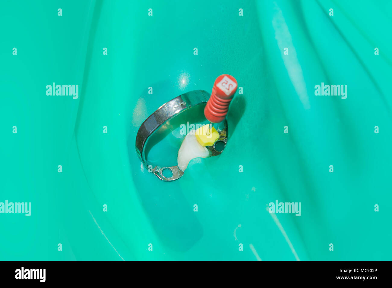 caries spoiled tooth closeup photographed through dental mirror Stock ...