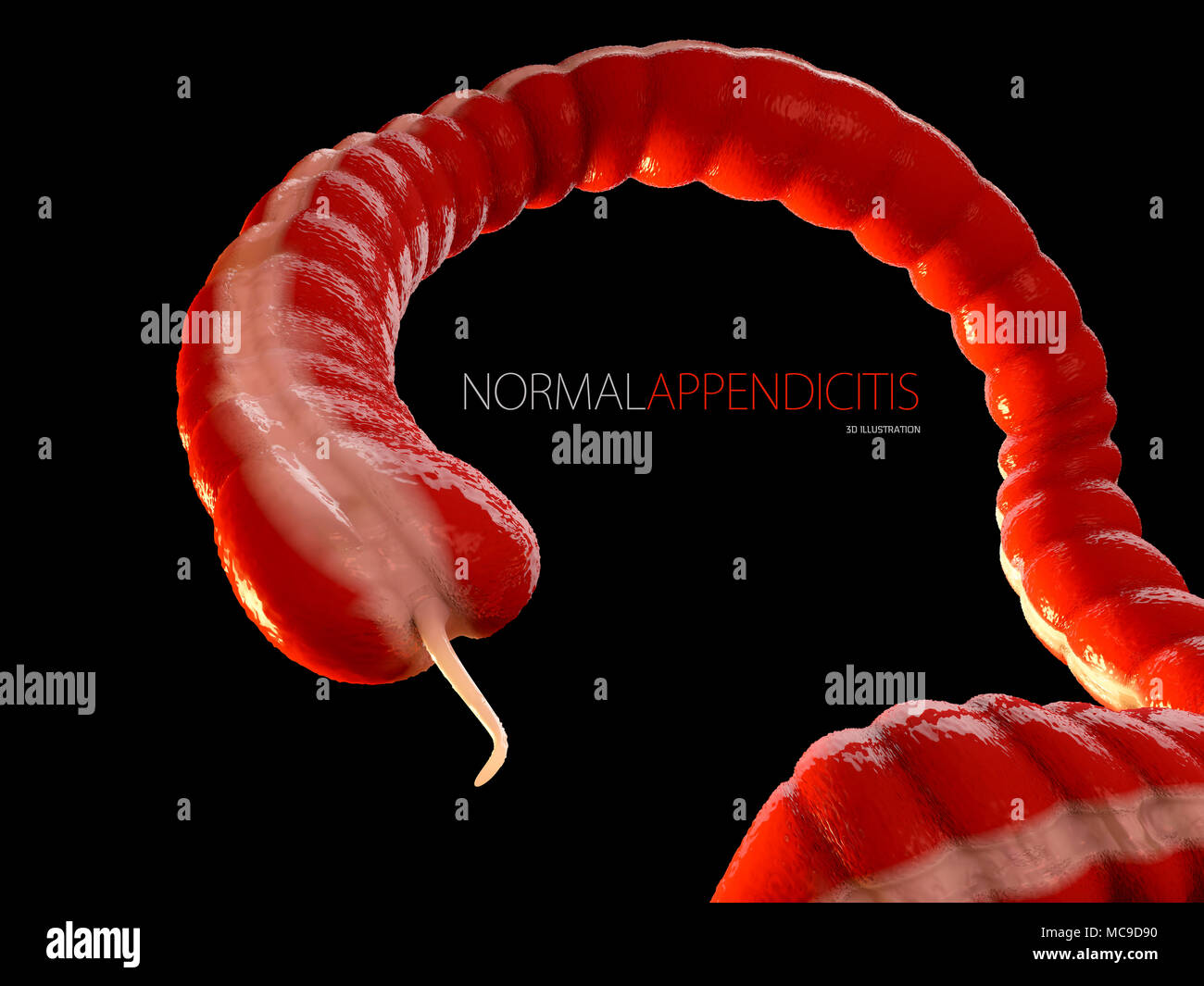 3D illustration of Appendicitis concept, human intestine anatomy ...