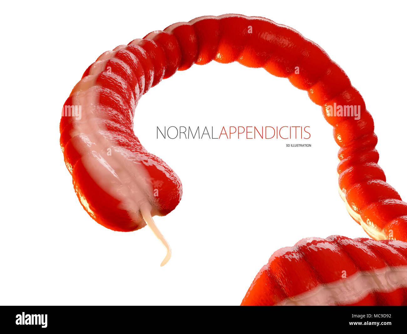 Appendicitis concept, human intestine anatomy as a 3D illustration ...