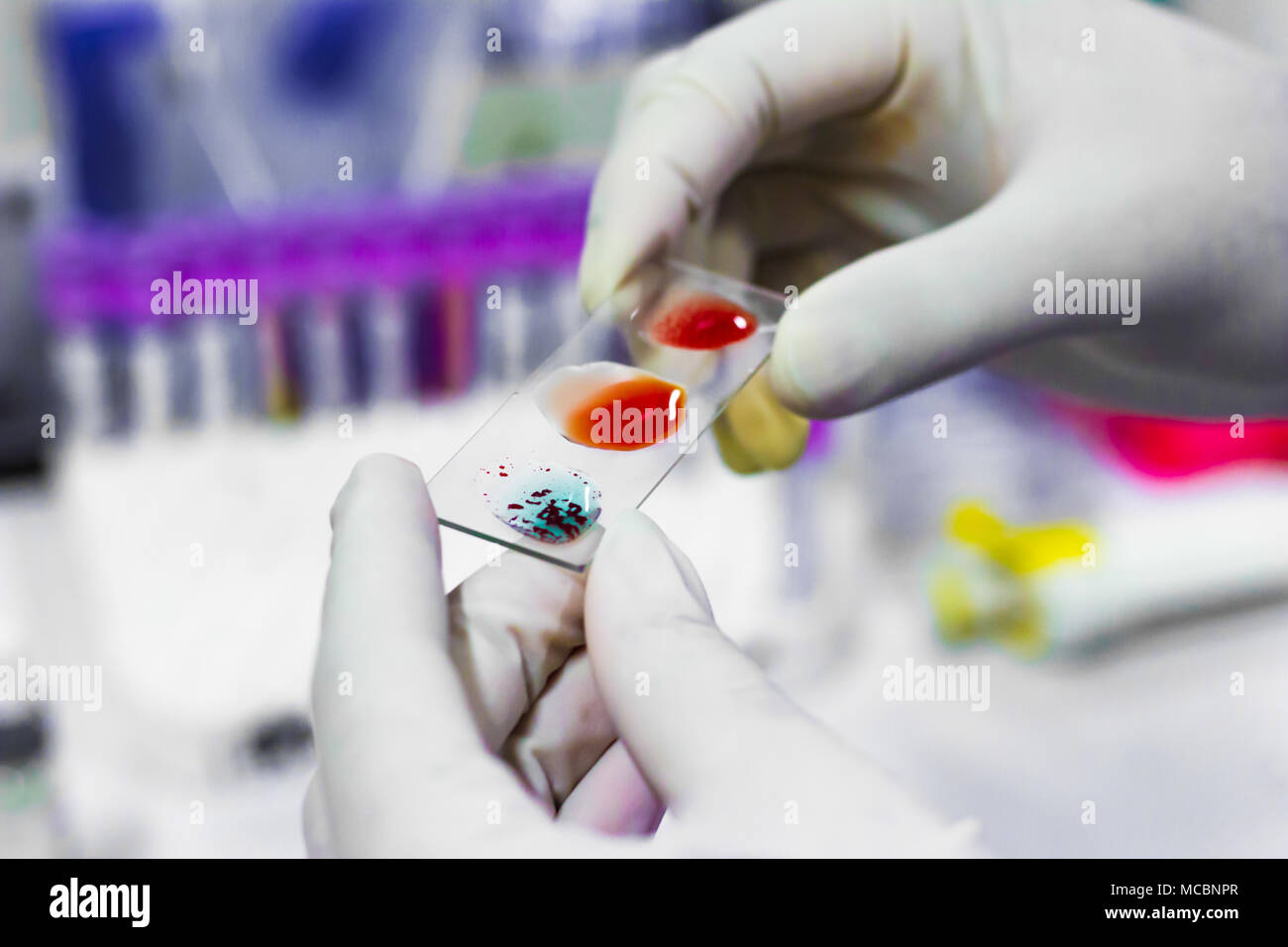 blood grouping on glass slide showing A+ group Stock Photo - Alamy