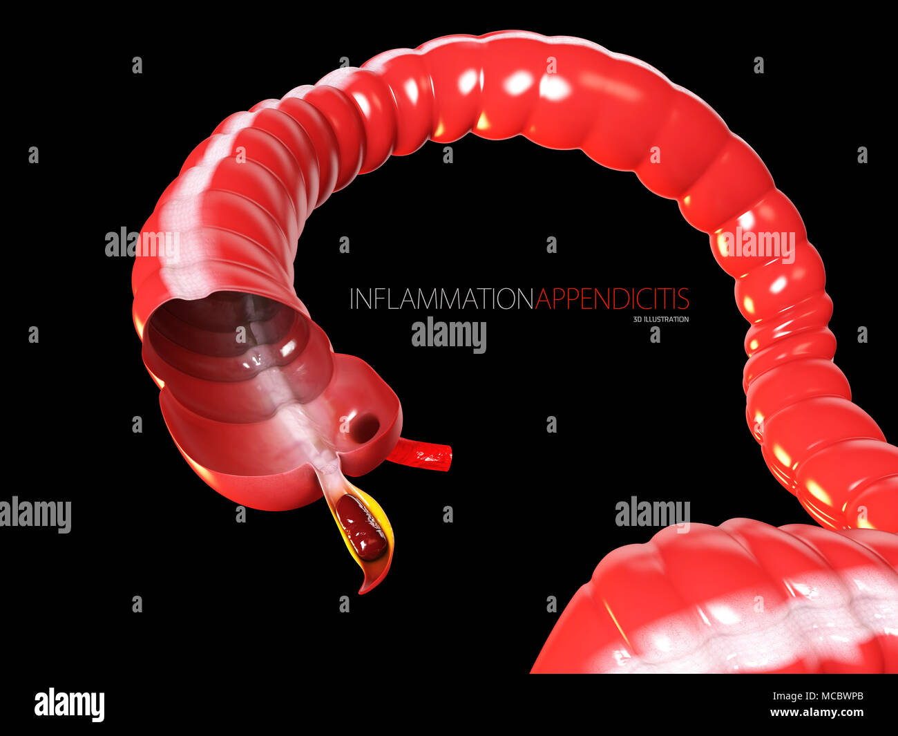 3D illustration of inflammation Appendicitis, human anatomy isolated ...