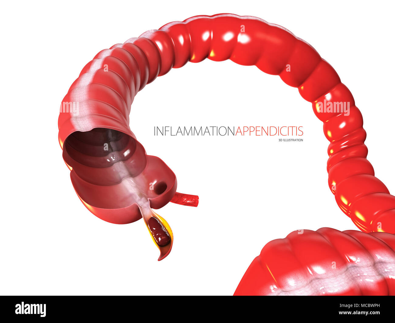 Inflammantion Appendicitis concept, human intestine anatomy as a 3D ...