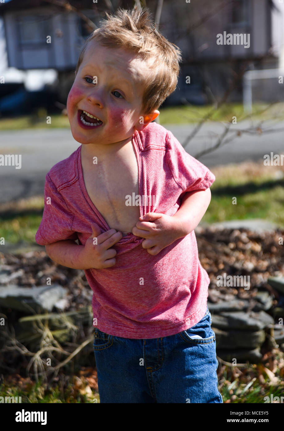 Heart surgery scar hi-res stock photography and images - Alamy