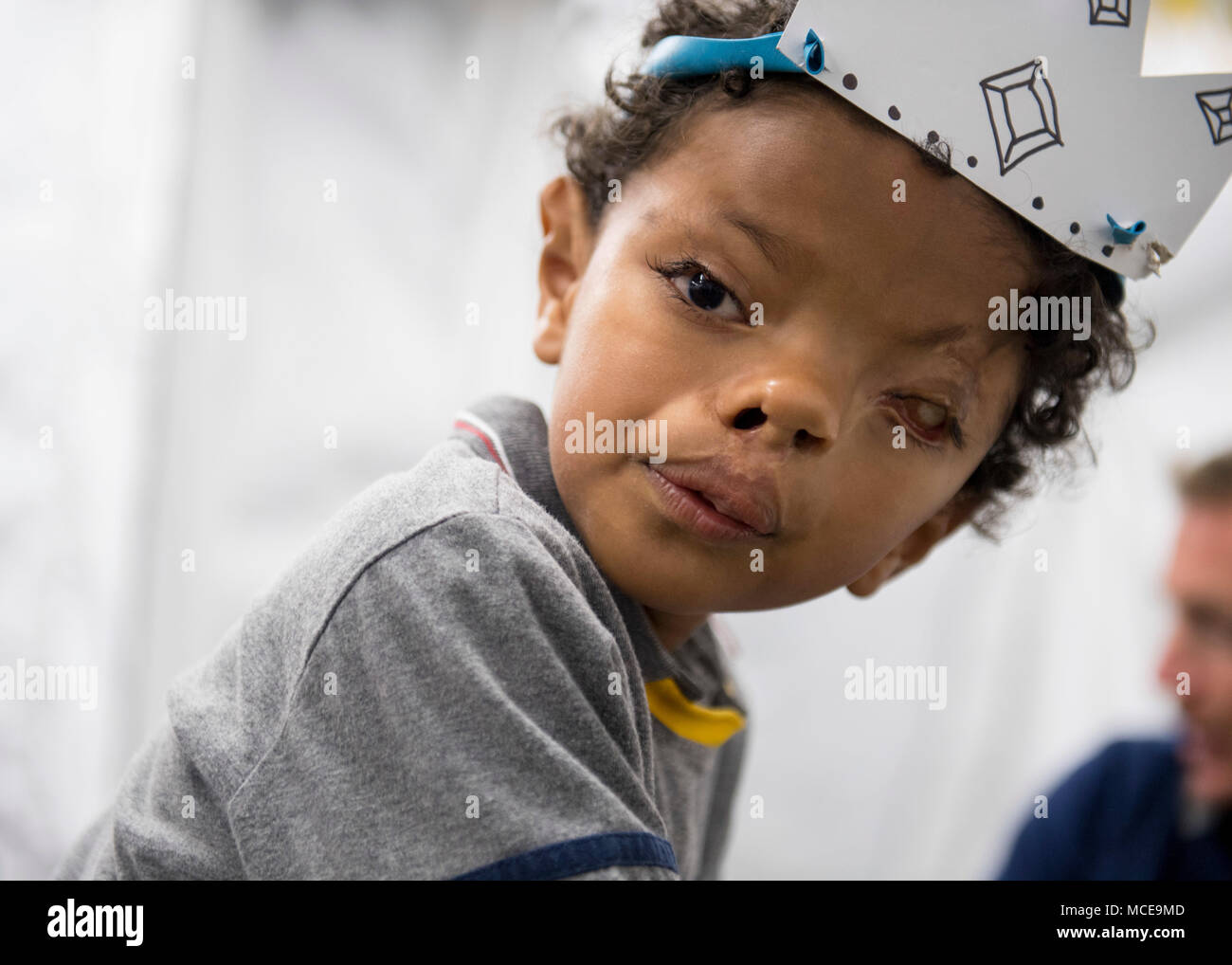 Facial deformity hi-res stock photography and images - Alamy