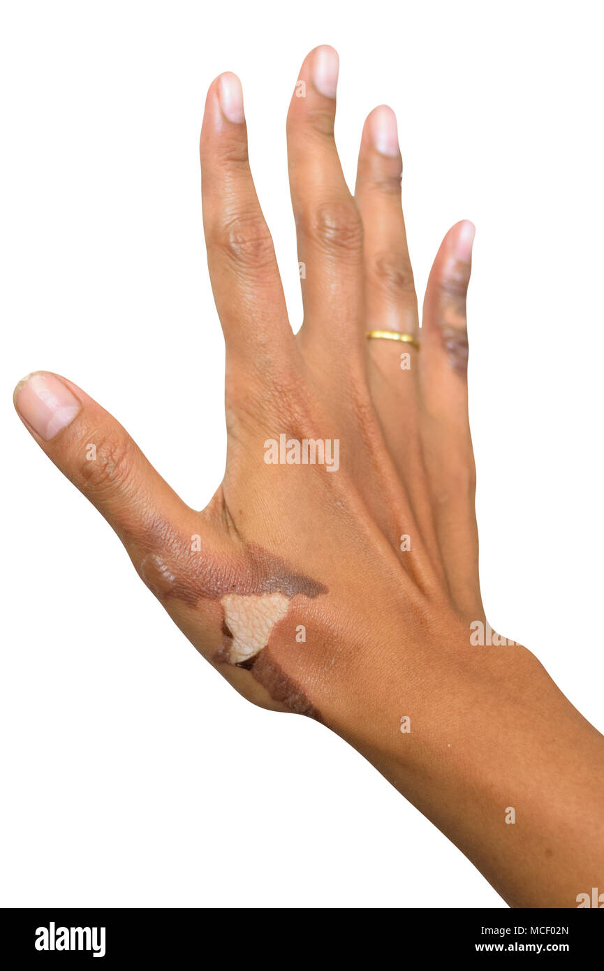 Hand burn hi-res stock photography and images - Alamy