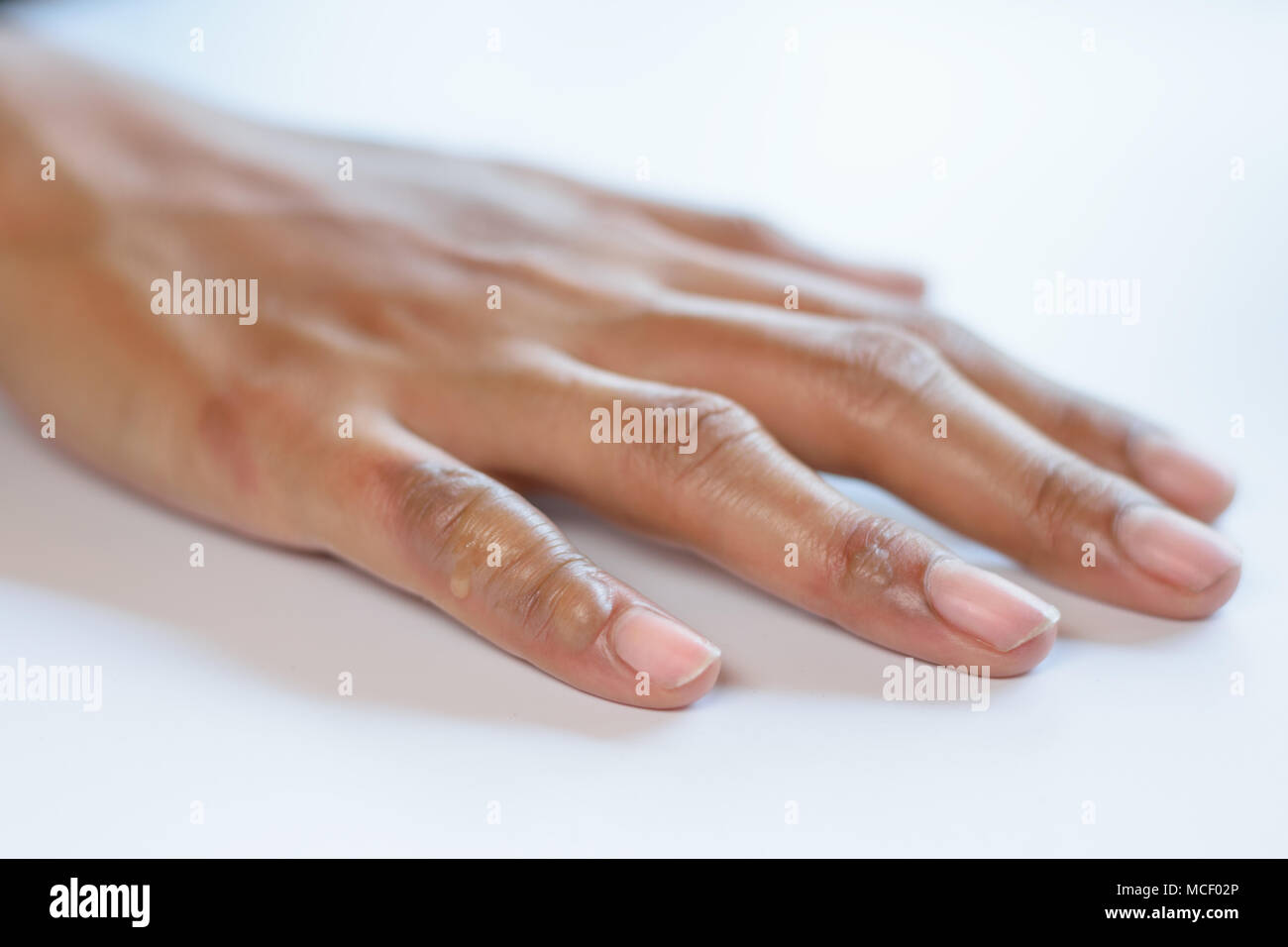 Scald hi-res stock photography and images - Alamy