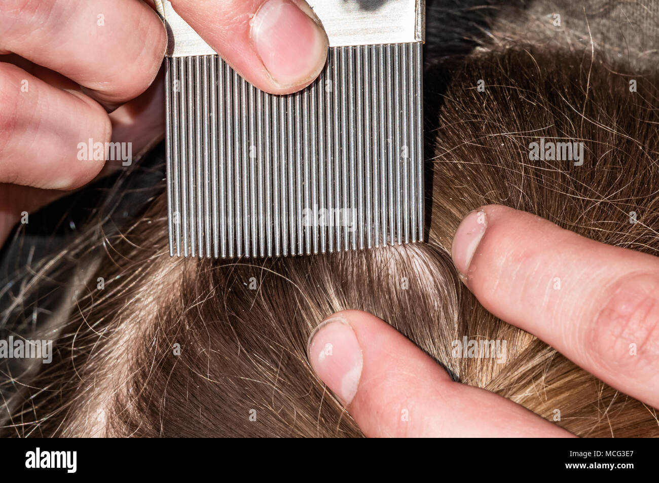 Head lice infection Stock Photo - Alamy