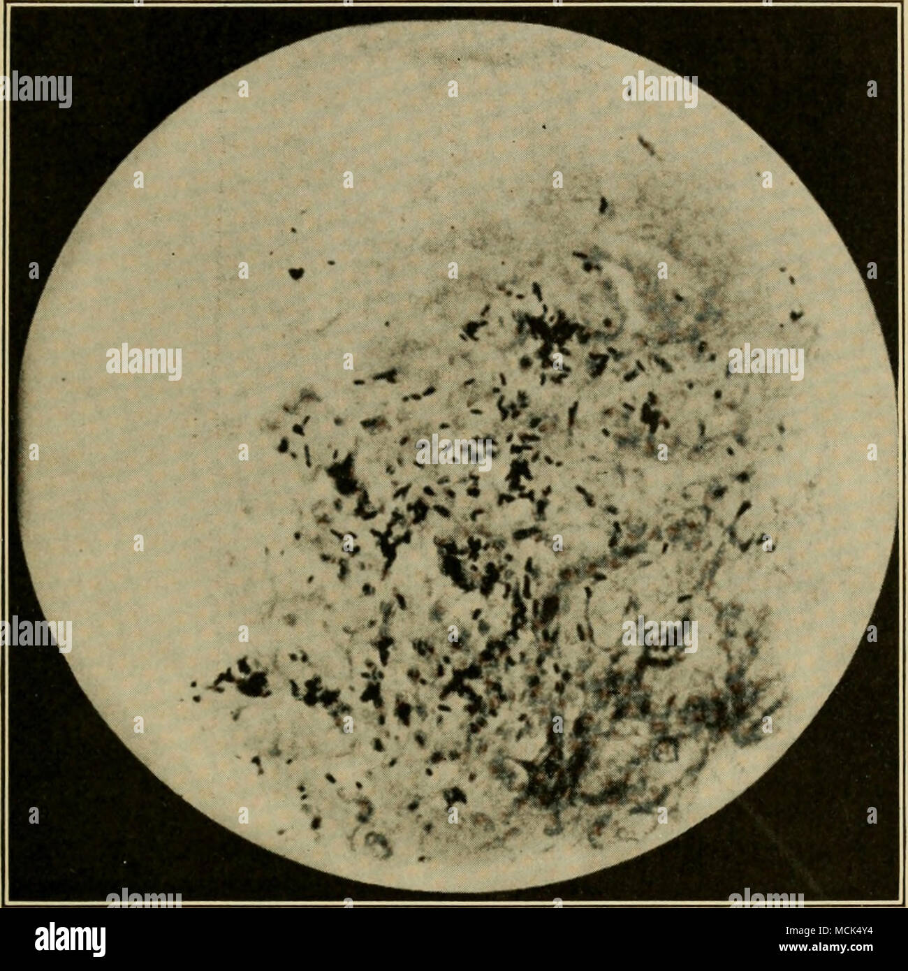 Tubercle Tuberculosis
