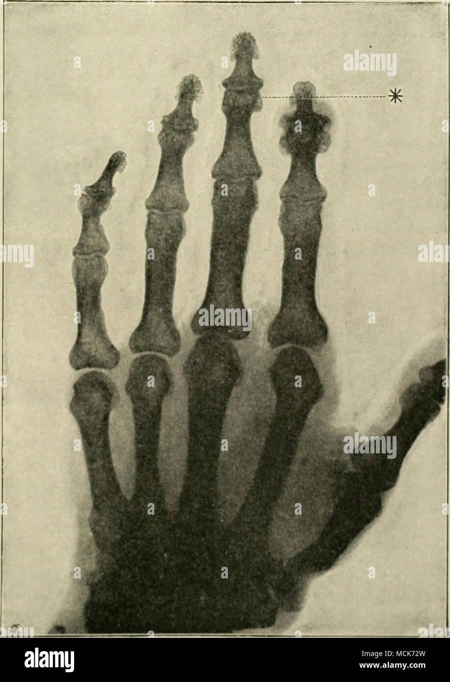 . Fio. 4. Röntgen P u Showing Heberden's Nodes upon ran Km - wn Littlh ...