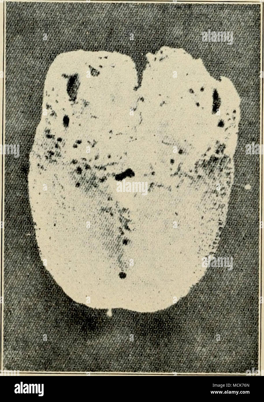 Periostitis hi-res stock photography and images - Alamy