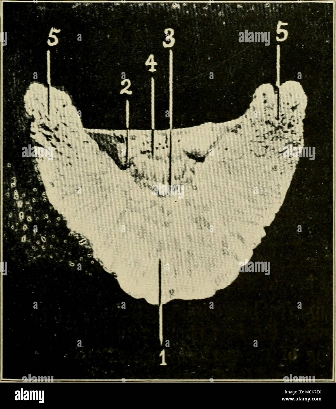 . Fig. 5.âThird Phalanx or Os Pedis (viewed from Below). 1, Plantar ...