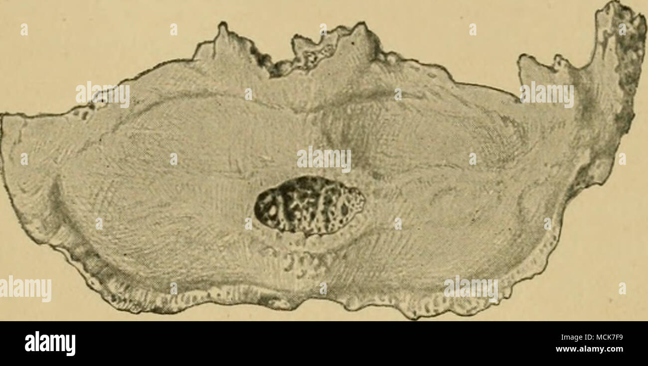 . Fig. 163.—The Navicular Bone from a Case of Long-standing Navicular ...