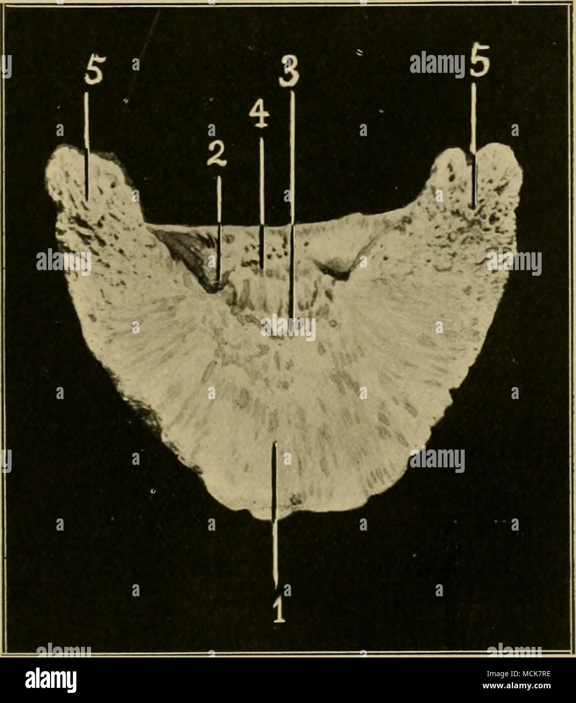 . Fig. 5.—Third Phalanx or Os Pedis (viewed from Below). 1, Plantar ...