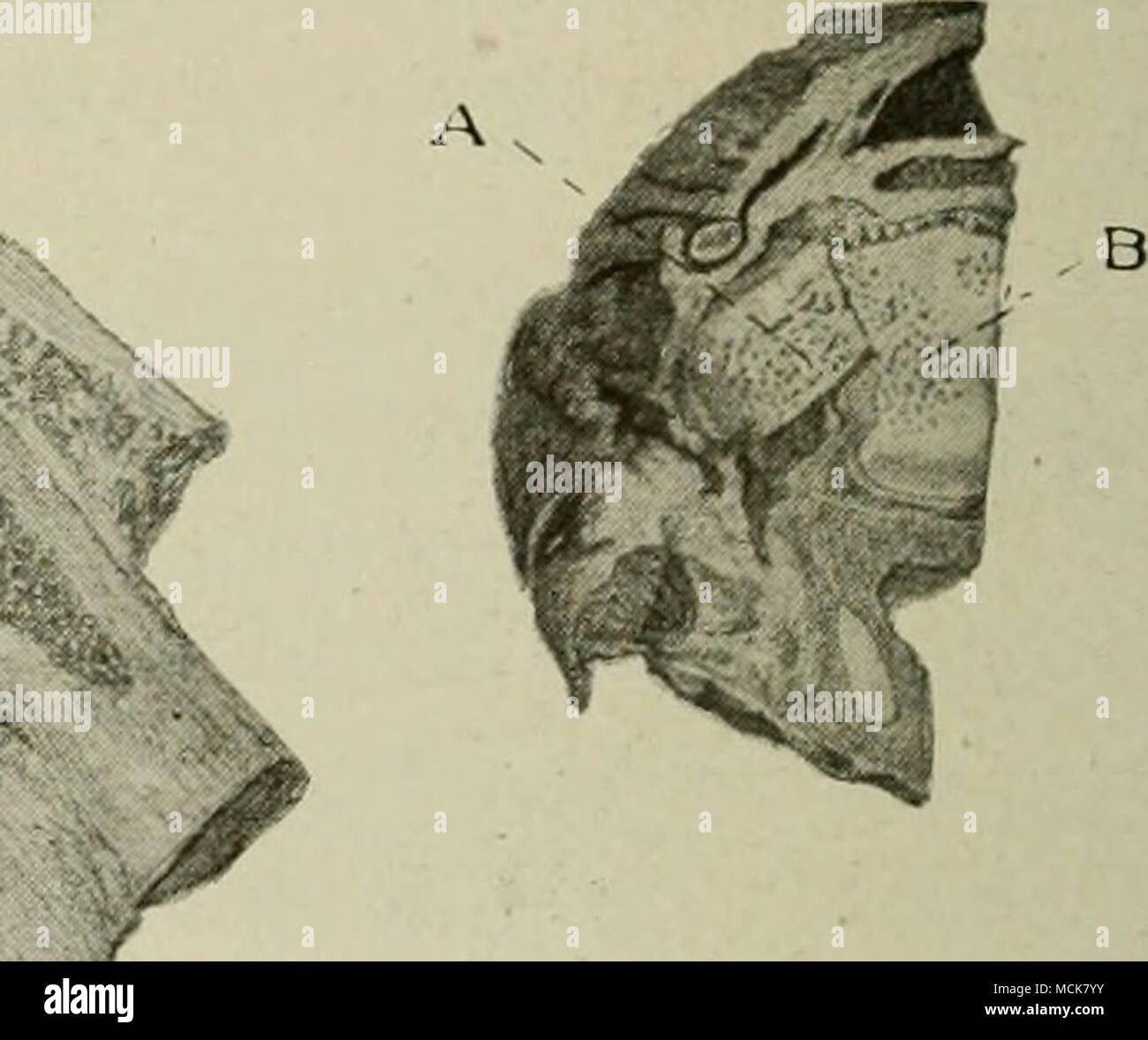 . Figs. 233, 234—Arthritis of Carpus. 233—Longitudinal section through ...