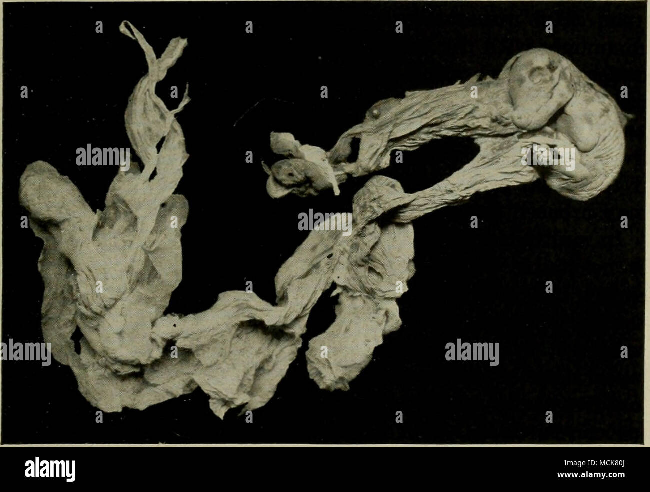 Full term fetus hi-res stock photography and images - Alamy