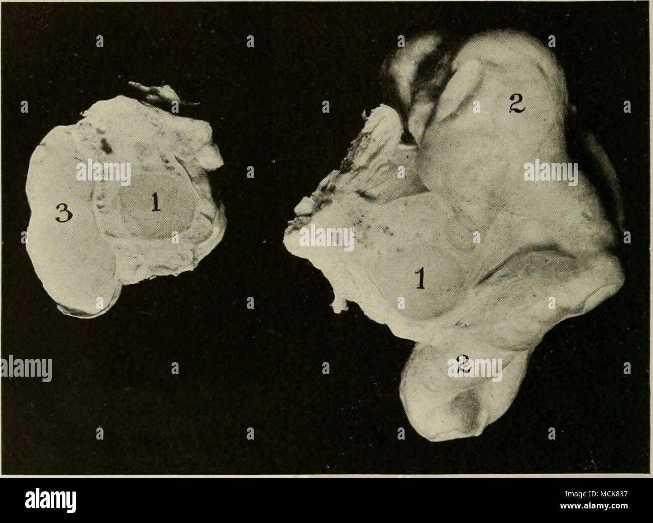 Hydrosalpinx hi-res stock photography and images - Alamy