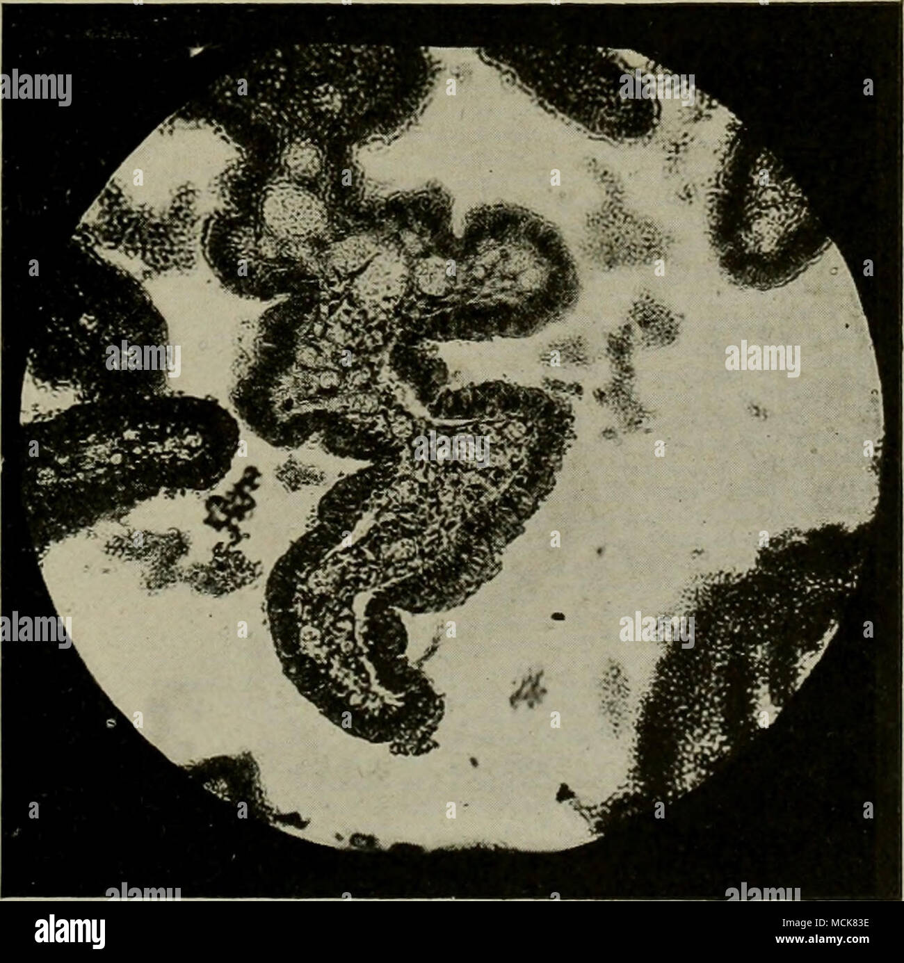 . Fig. 150—Highly Magnified Fold of the Mucosa in the Acute Stages of ...