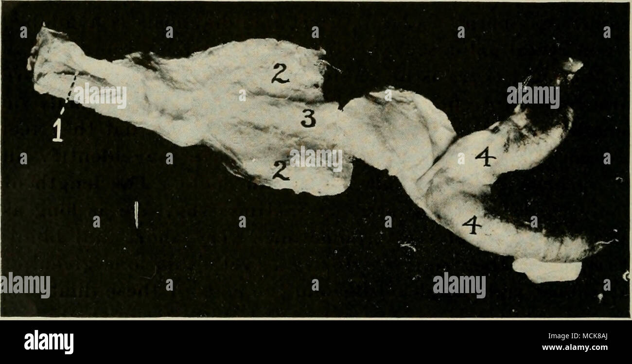 Cervical canal of uterus hi-res stock photography and images - Alamy
