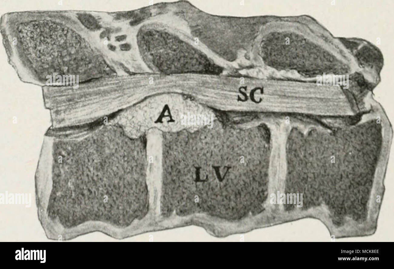 . Fic. 2u6—Pyaemic Abscess in Spinal Canal of Calf. •Sd", Spinal ronl ...
