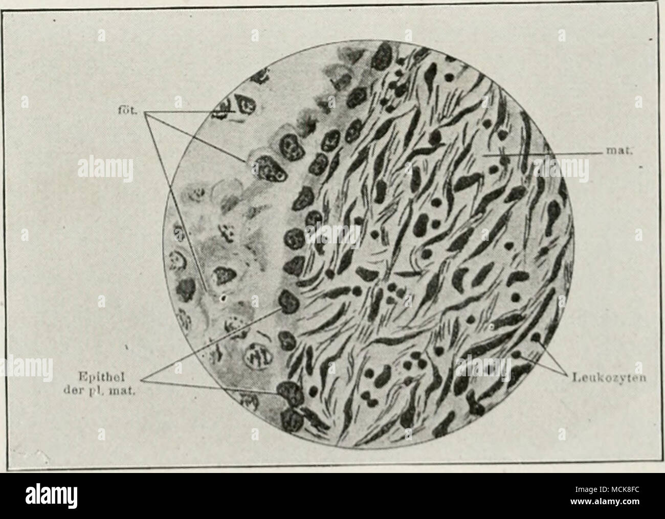 . Fig. 182—Retained Placenta. Necrotic disintegration of fetal tufts ...