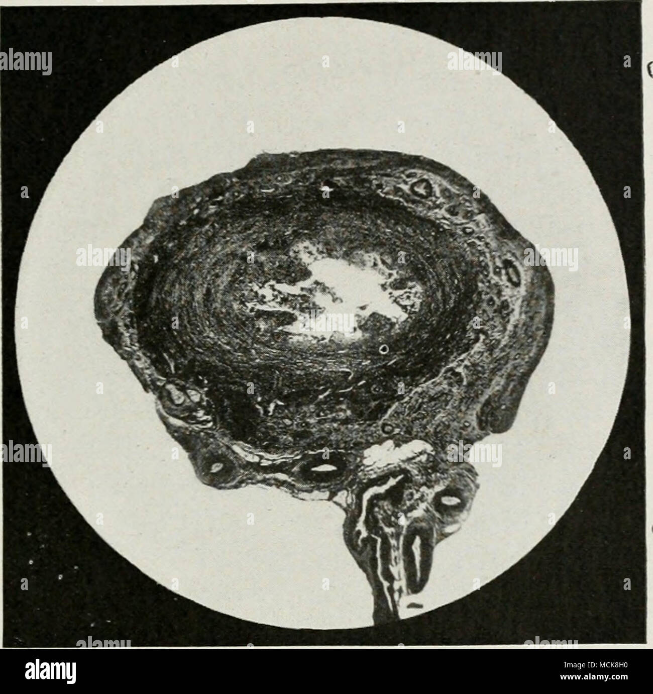 Salpingitis hi-res stock photography and images - Alamy