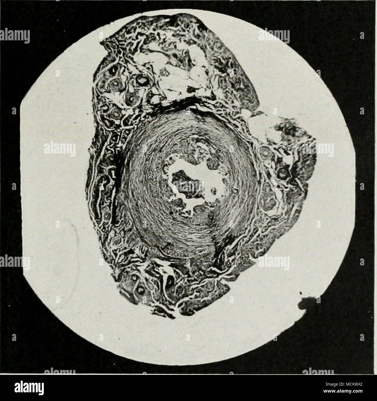 . Fig. 146—Chronic Catarrhal Salpingitis, with Marked Edema of the Wall ...