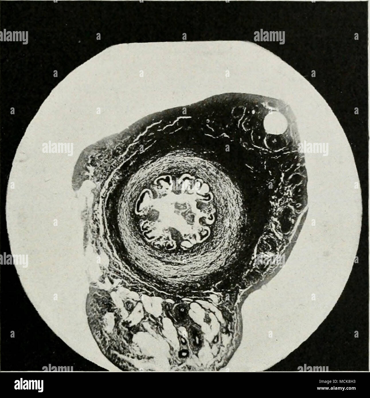Catarrhal High Resolution Stock Photography and Images - Alamy