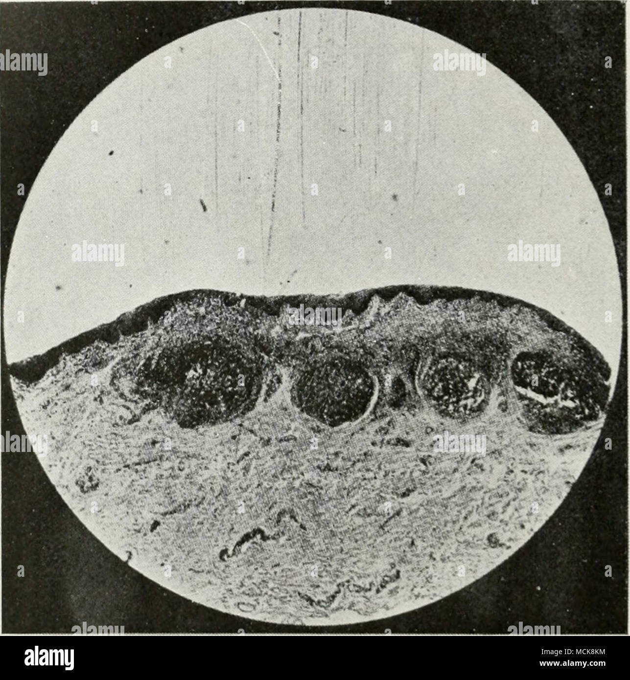 . Fic. 89Section through four contiguous nodules which cause a single ...