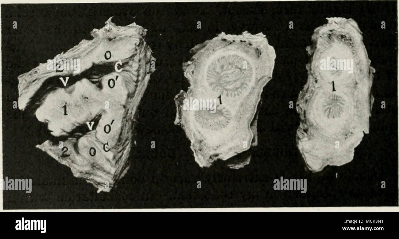 . I'u;. 55—Double Cervix. Cow. /, /, /, Persistent niedian i)artition ...