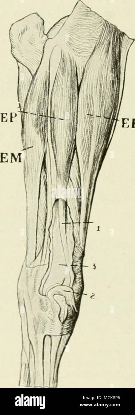 Ruptured extensor tendon hi-res stock photography and images - Alamy