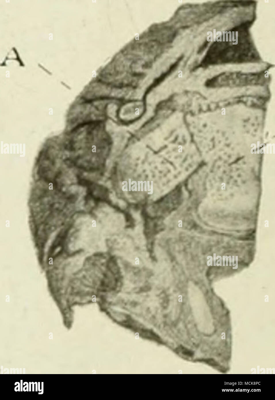 Abscess abscesses hi-res stock photography and images - Alamy