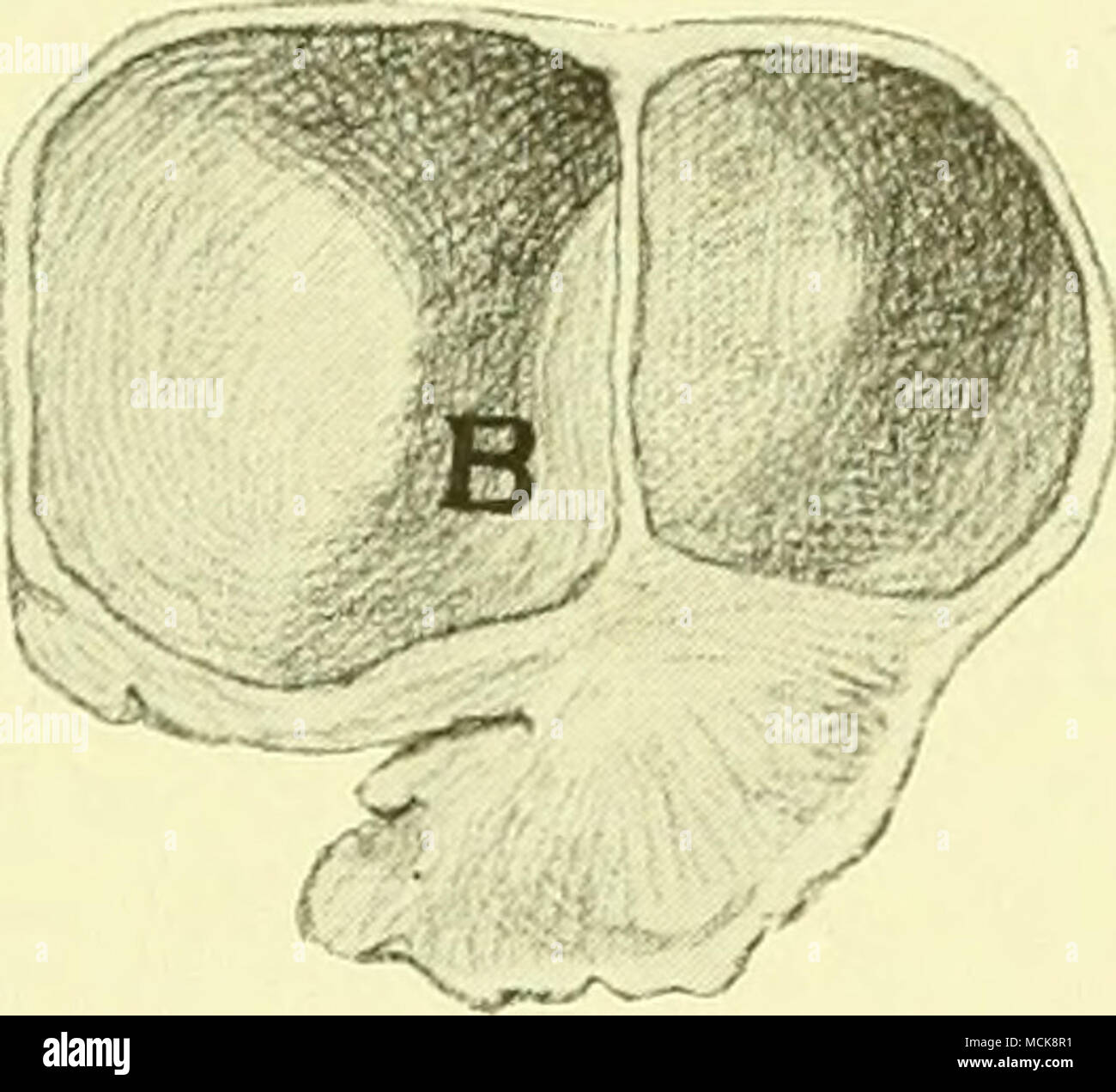 Tunica albuginea cysts hi-res stock photography and images - Alamy