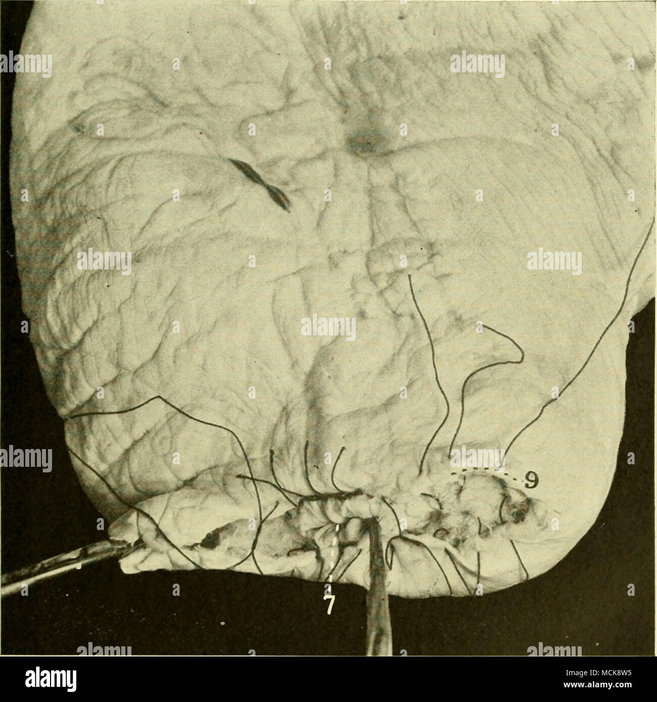 . Fir,. 203—Circular Amputation of Cervix Uteri. Showing cervix after ...