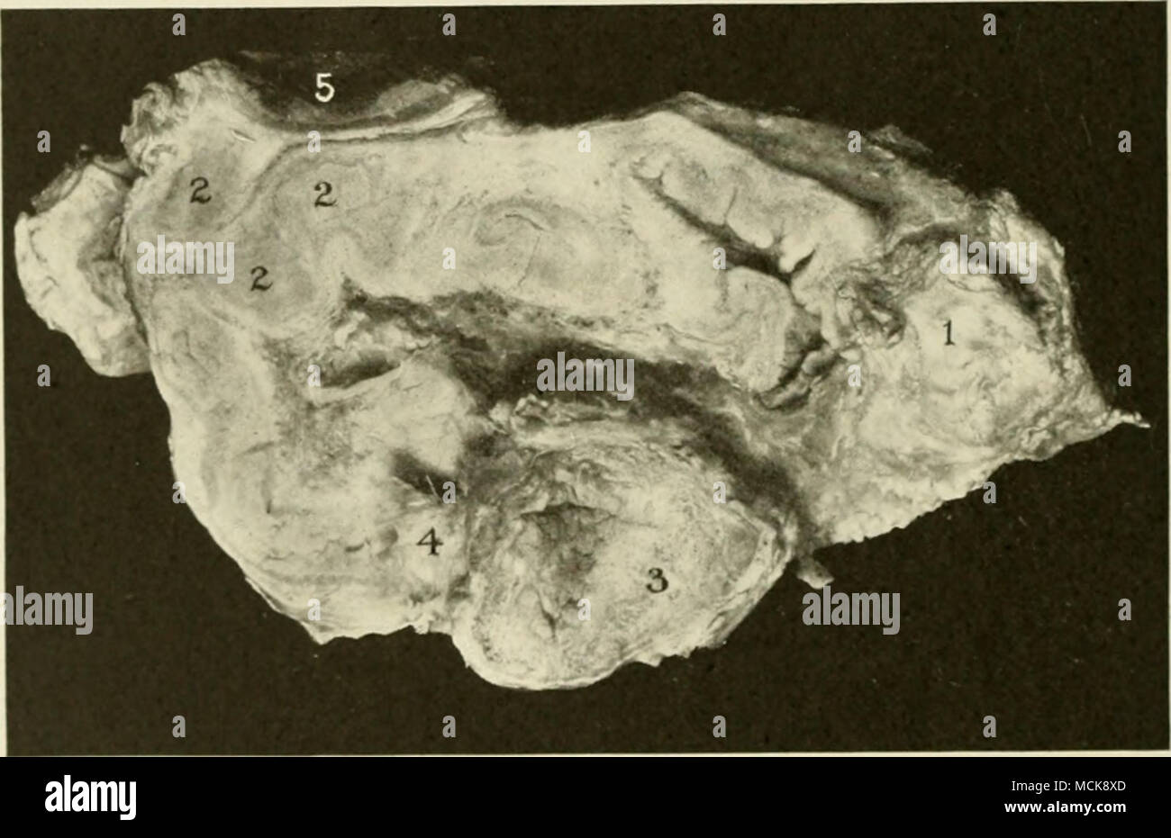Abscess abscesses hi-res stock photography and images - Alamy