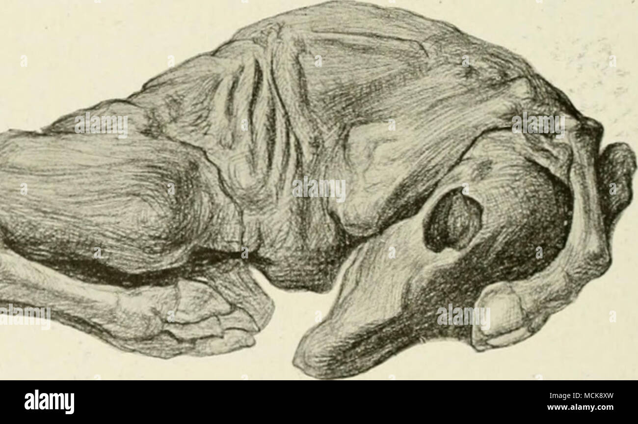 . FlG. i6S—-Complete Desiccation of Fetus following Inter- Placental ...